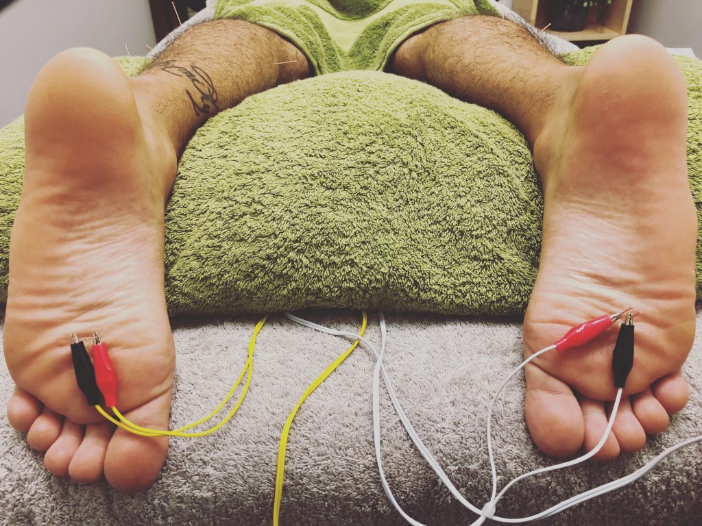 Electro Acupuncture - The Acupuncture Room Hills District